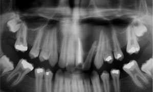 Treatment of a Large Maxillary Cyst with Marsupialization ...