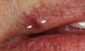 The Clinical Value of Diascopy | jcda